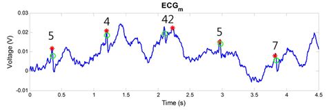 detected r peaks in ecg measured by cecg the numbers on the detected r