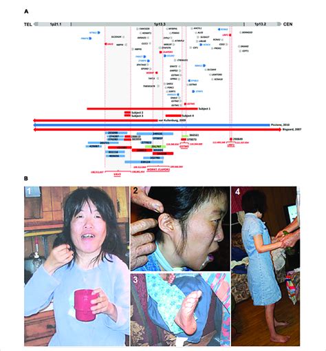 a comparative cnv mapping of subjects with cnvs at 1p13 3 deletions