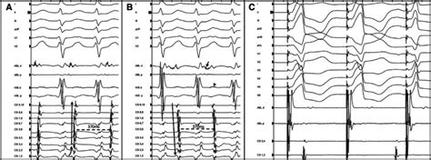 Intra Atrial Conduction Block During Radiofrequency Ablation Of Left