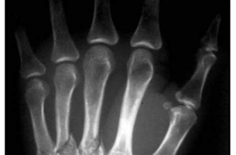 Metacarpal Fractures Core Em