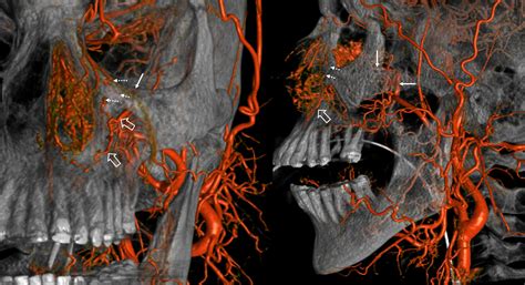Infraorbital Artery