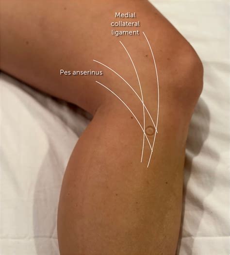 Injections Of The Hip And Knee Aafp