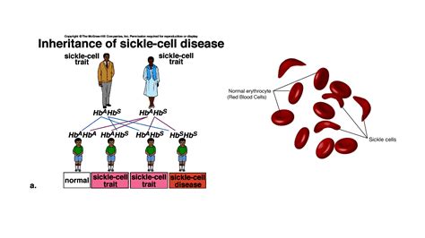 sickle cell anemia inheritance