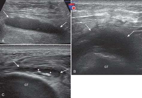 УЗИ тазобедренного сустава после эндопротезирования