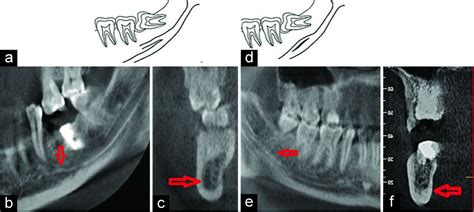 Assessing The Prevalence And Morphological Characteristics Of Bifid Mandibular Canal Using Cone