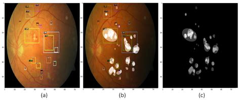 Detectron2 For Lesion Detection In Diabetic Retinopathy