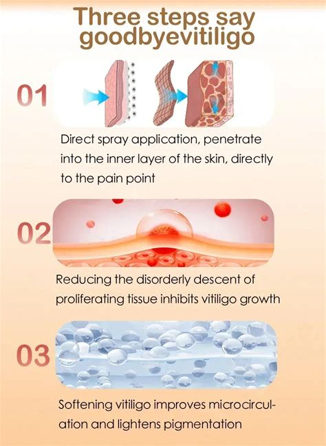 Крем для лечения Vitiligo спрей для облегчения Vitiligo лампа для лечения кожи мазь для