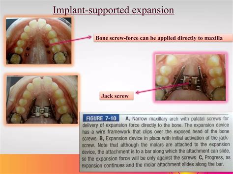 Hygenic Rapid Maxillary Expansion In Orthodontics Ppt