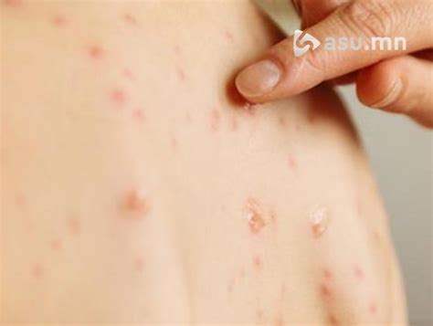 Улаанбаатар хотын Ерөнхий Боловсролын 22 сургуульд Улаанбурхан өвчин бүртгэгджээ