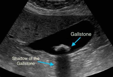 Evaluations Of Gallbladder Disease And Function Dssurgery
