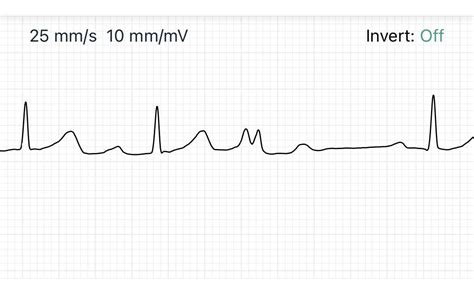 Afib Pacs R Afib