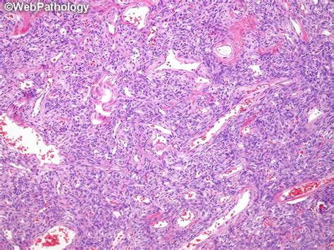 Solitary Fibrous Tumor Histology