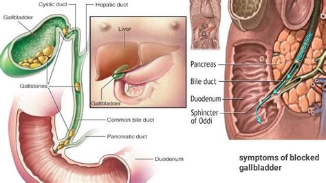 Symptoms Of Blocked Gallbladder Blockage Gallbladder Gallbladder