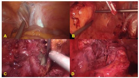 Surgical Treatment Of Localised Pelvic Lymphocyst Infection After