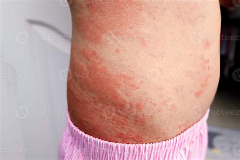 Strong Allergic Rashes On The Body Impaired Immunity And Reaction To