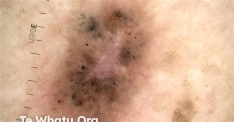 Nodular Basal Cell Carcinoma Dermoscopy Image