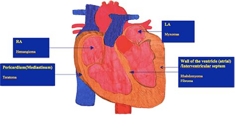 Cardiac Rhabdomyoma