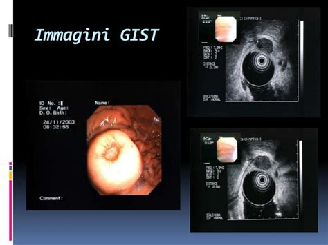 Ppt Gist Diagnosi Endoscopica Powerpoint Presentation Free Download Id 224094