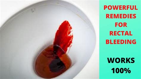 Rectal Bleeding What Causes Rectal Bleeding Rectal Bleeding Treatment Youtube