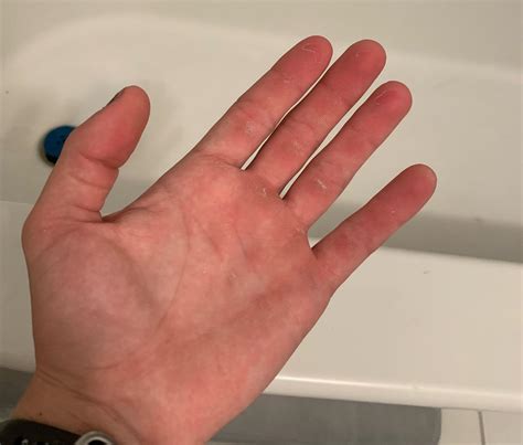 Its Been A While Since Ive Had My Calluses Rip And It Feels Good R