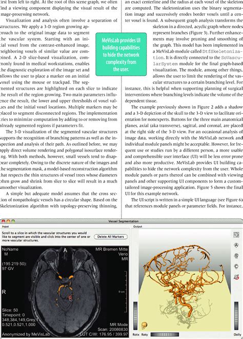 The Final Ui Of The Vascular Segmentation Example The Complexity Of