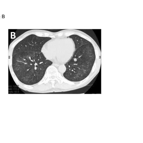 Ct Scan Of The Chest Revealed Nonspecific Reticulonodular Infiltrates Download Scientific