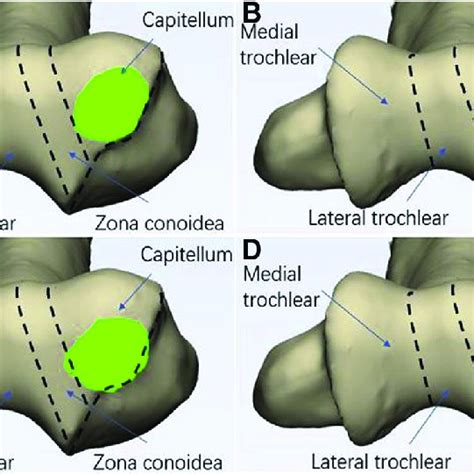 The Common Contact Area Of The Radiocapitellar Joint In The Capitellar Download Scientific