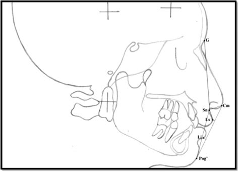 E Showing Cephalometric Soft Tissue Angular And Linear Measurements