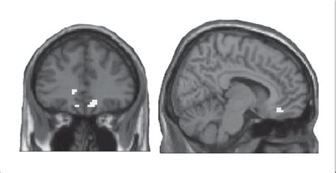 Differential Activation Of The Orbitofrontal Cortex Ofc During