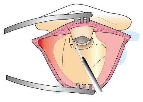 11 Obliteration Of The Middle Ear Subtotal Petrosectomy In