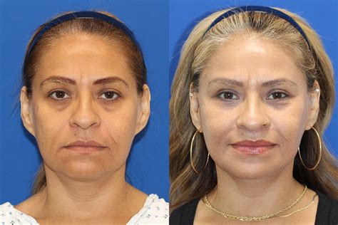 Patient 330064 Vertical Restore® Facial Rejuvenation Before And After