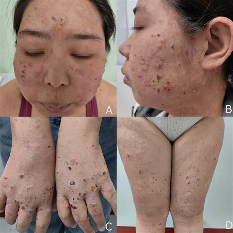 The Erythematous Macules And Vesicles Are Scatteredly Distributed On