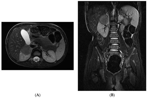Prechemotherapy Transperitoneal Robotic Assisted Partial Nephrectomy Rapn For A Wilms Tumor