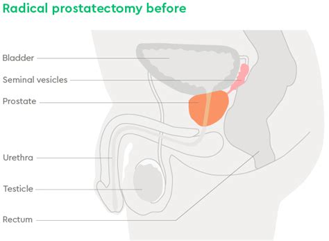 Radical Prostatectomy