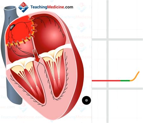 Atrial Depolarization