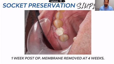 Webinar The Socket Inside And Out The Dawson Academy