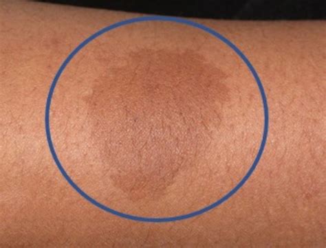 Do Not Be Rash With Rashes A Guide To Dermatological Description Rcemlearning India