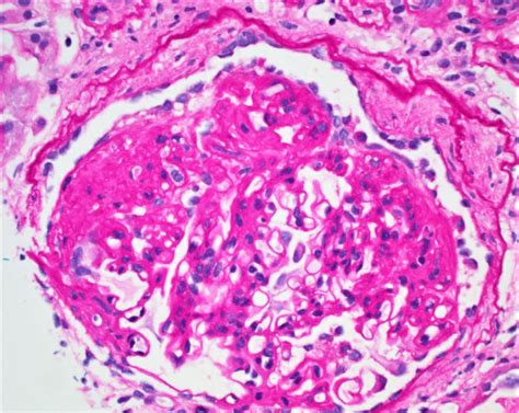 Pathology Outlines Obesity Related Glomerulopathy