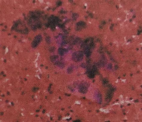 The Abnormal Epithelial Cells Exhibited Hyperchromatic Or Faintly Download Scientific Diagram