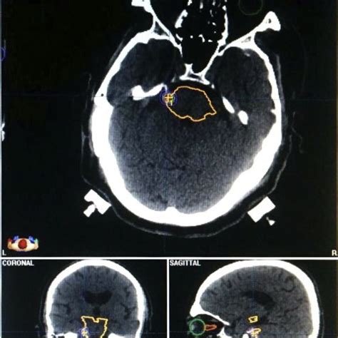 Example Of Radiosurgery Planning With Brainlab ® Software Using Ct