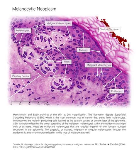 Medicalillustrator Histology Cells Melanoma Neoplasm Melanocytic