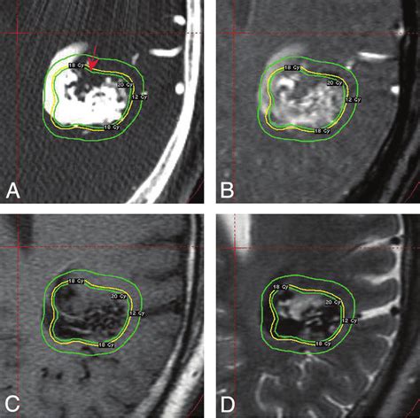 a 4d dsa of a 53 year old man with a larger and more intricate avm