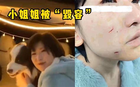 小姐姐作死亲吻陌生狗狗，当场被咬“毁容”，太惨了 哔哩哔哩