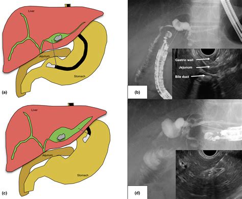 Endoscopic Ultrasonography‐guided Hepaticogastrostomy With Novel Two‐step Puncture Technique