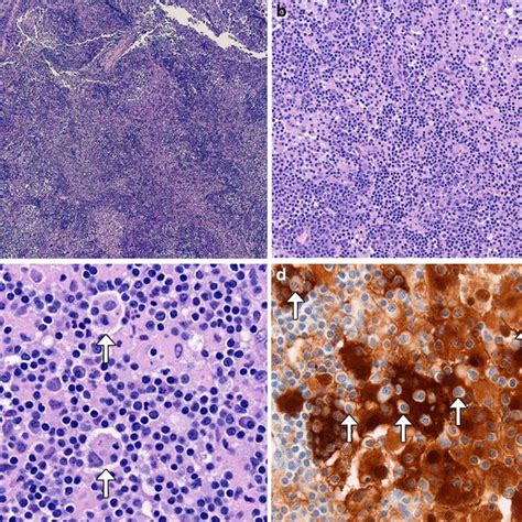 Hyperpigmented Indurated Plaque With Superimposed And Satellite