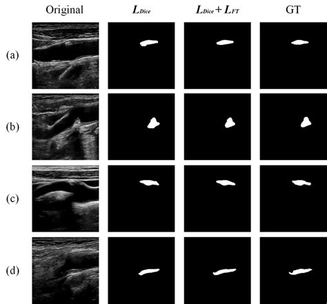 Qualitative Comparison Of Carotid Plaque Segmentation Results Produced Download Scientific
