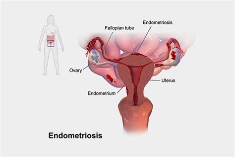 Endometriosis Excision Surgery In Ahmedabad Dr Sandip Sonara