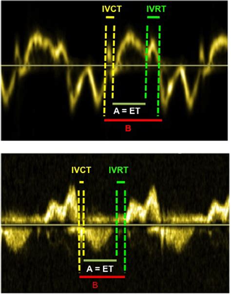 Myocardial Performance Index Mpi Or Tei Index Obtained From Tissue