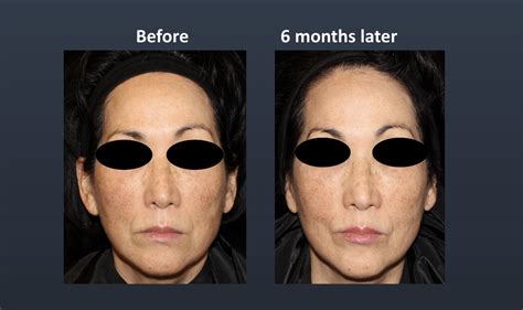 Exosomes Therapy Exosomes Treatment Prp Alternative