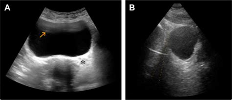 Point Of Care Ultrasound Of The Urinary Tract Medical Clinics